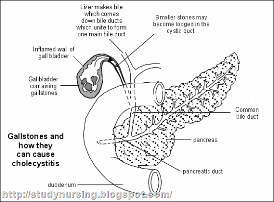 Cholecystitis | studynursing